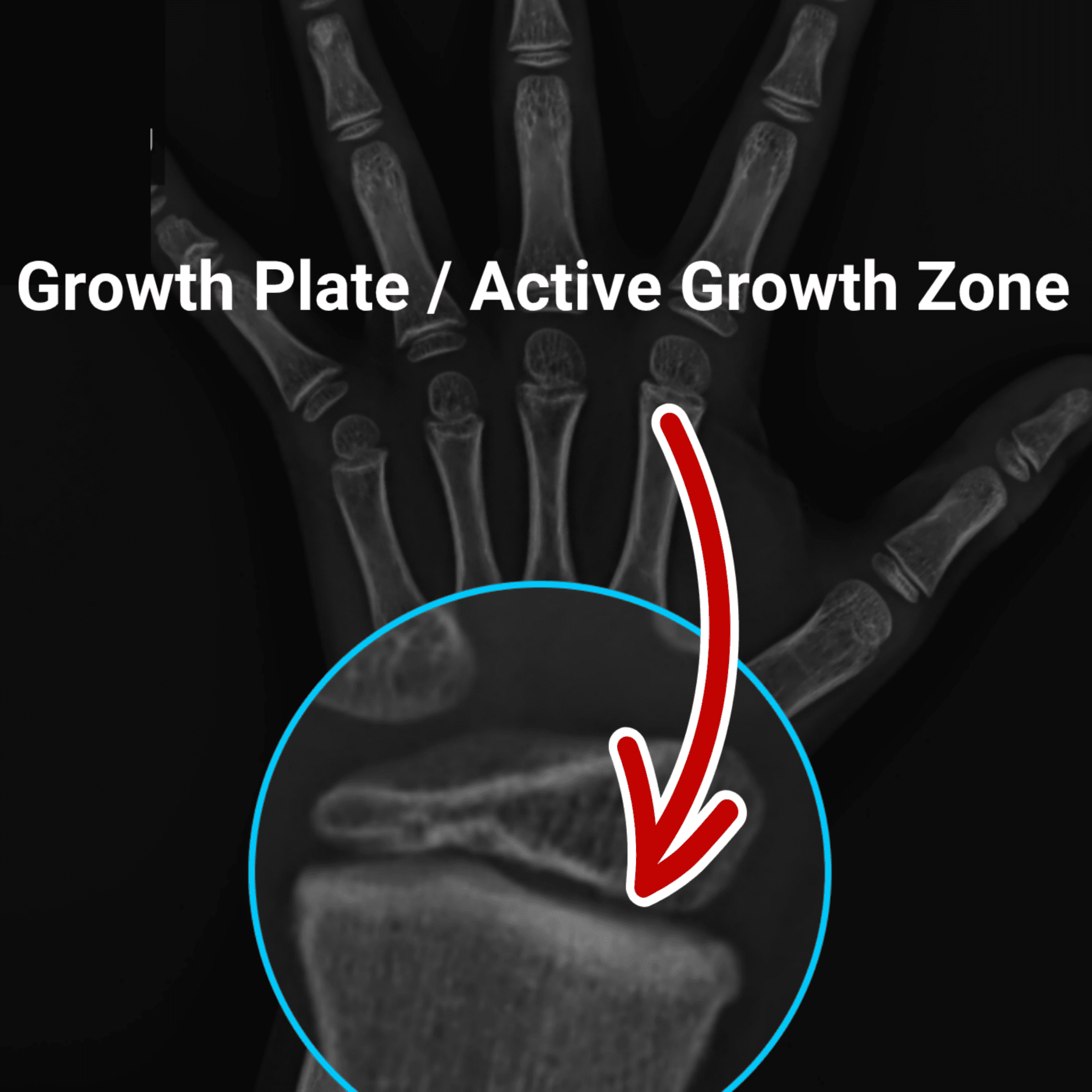 Bone Age X-Ray: What Your Child's Growth Plate Results Actually Mean