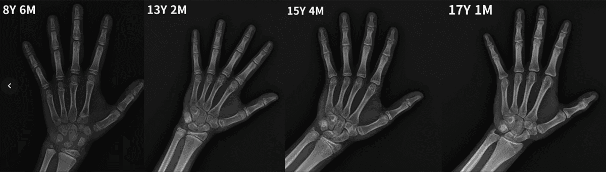 Bone Age X-Ray: What Your Child's Growth Plate Results Actually Mean